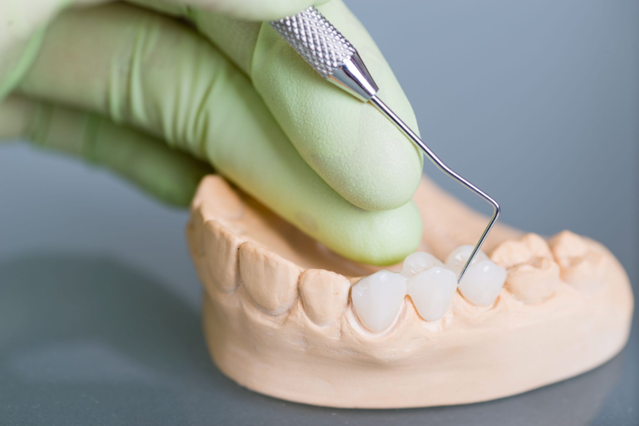 Restoration Rescue: How to Handle a Lost Dental Bridge | North ...